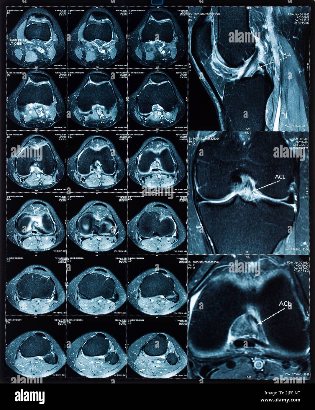 Mri kniegelenk -Fotos und -Bildmaterial in hoher Auflösung – Alamy