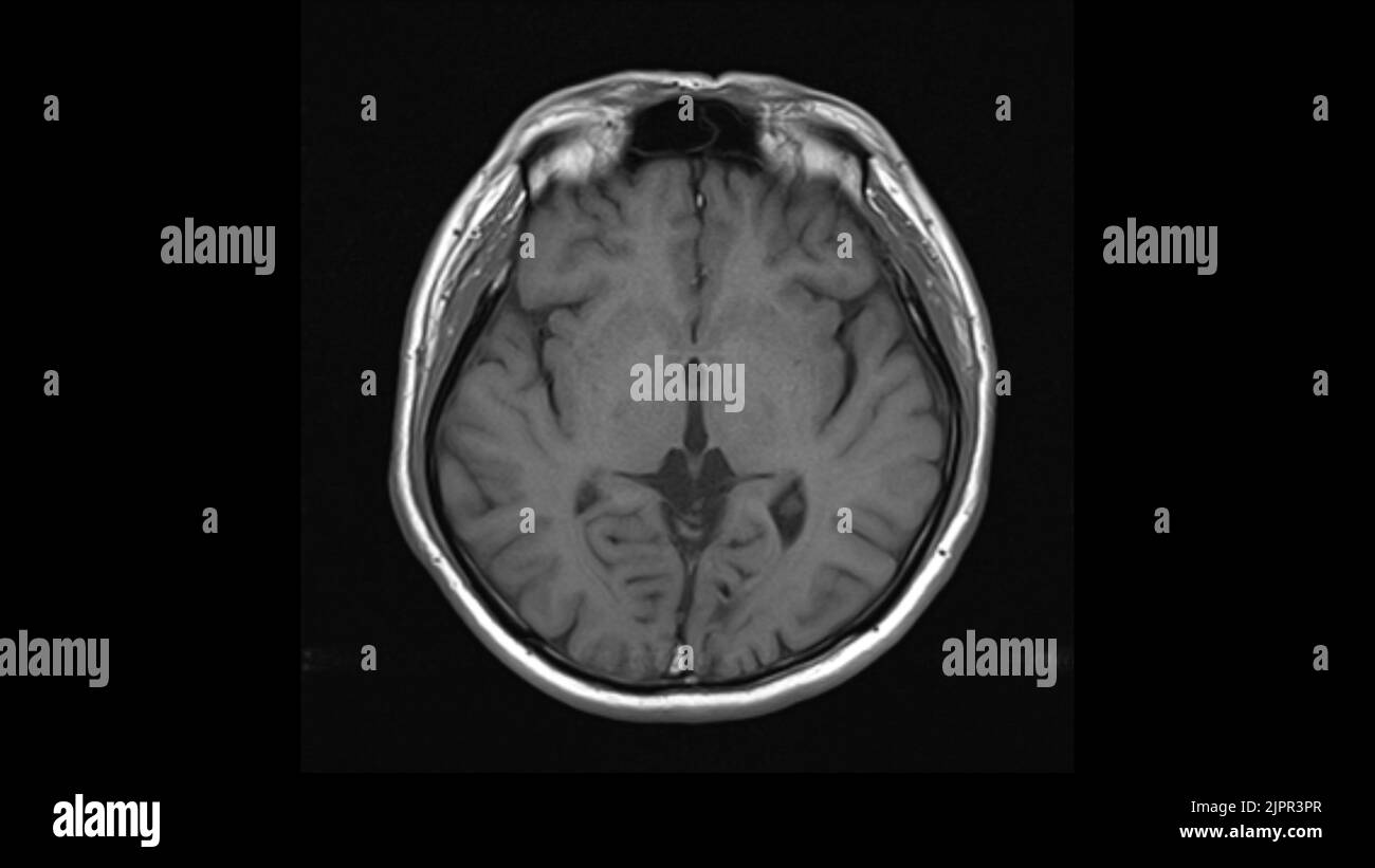 Röntgenaufnahme gehirn gesund -Fotos und -Bildmaterial in hoher Auflösung – Alamy