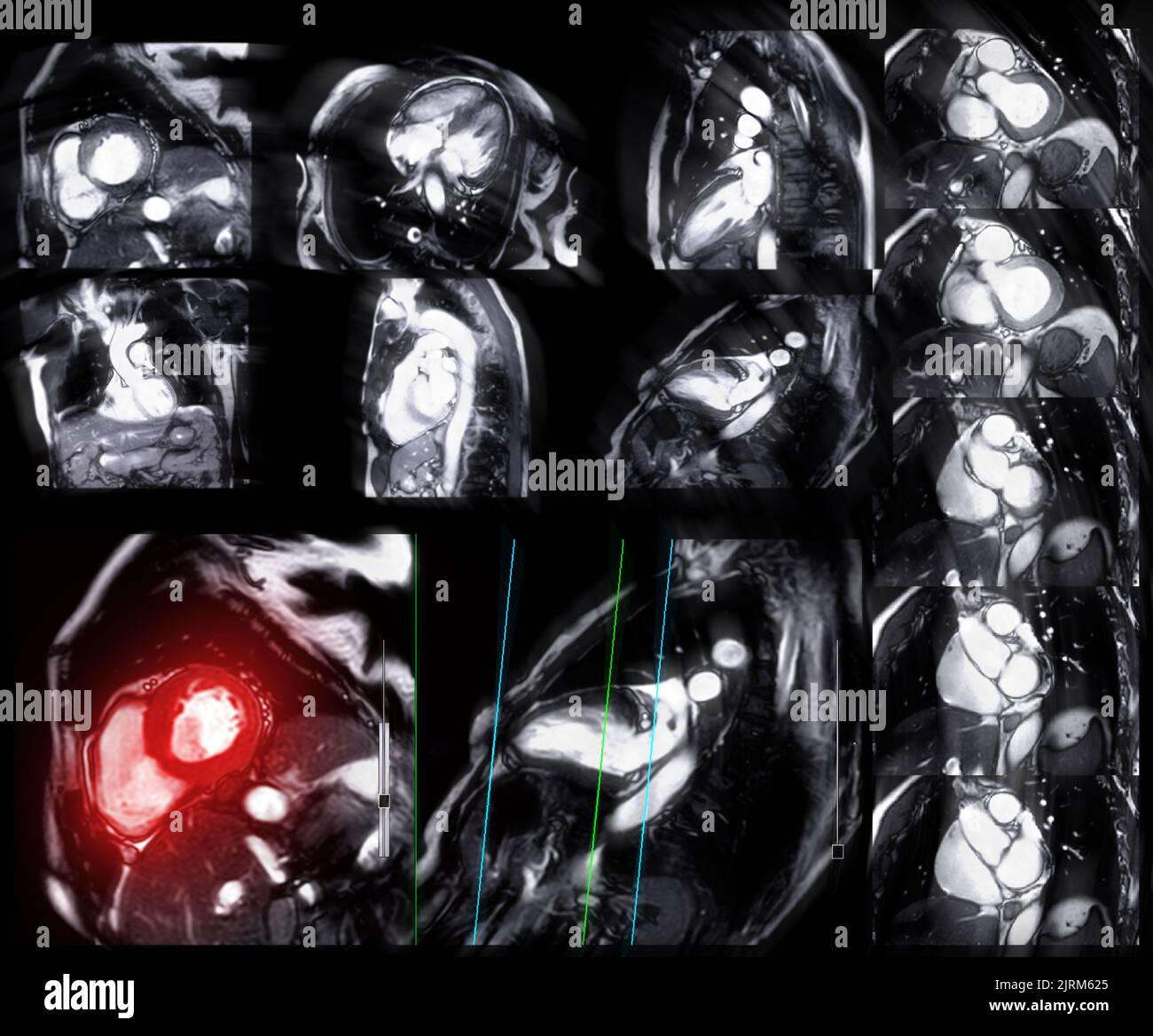 Sammlung von MRT Herz- oder Herz-MRT (Magnetresonanztomographie) von ...