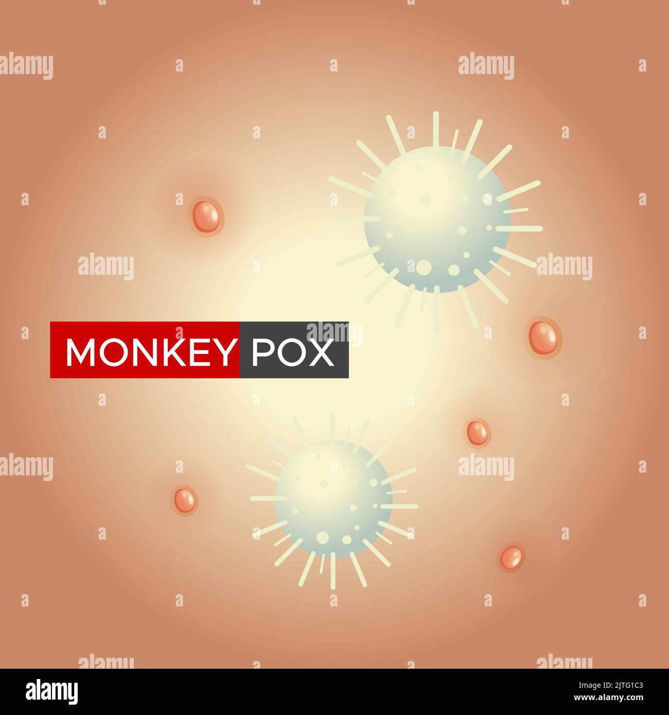 Monkeypox - Hautausschläge und Flecken als Symptome - Symbol als EPS 10 ...