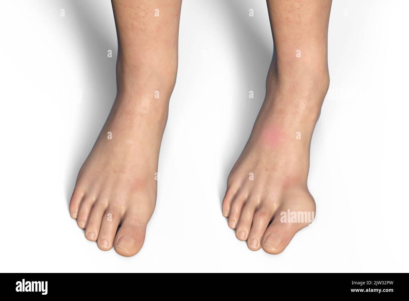Hallux valgus, Illustration. Ein Hallux valgus, oder Bunion, ist eine ...