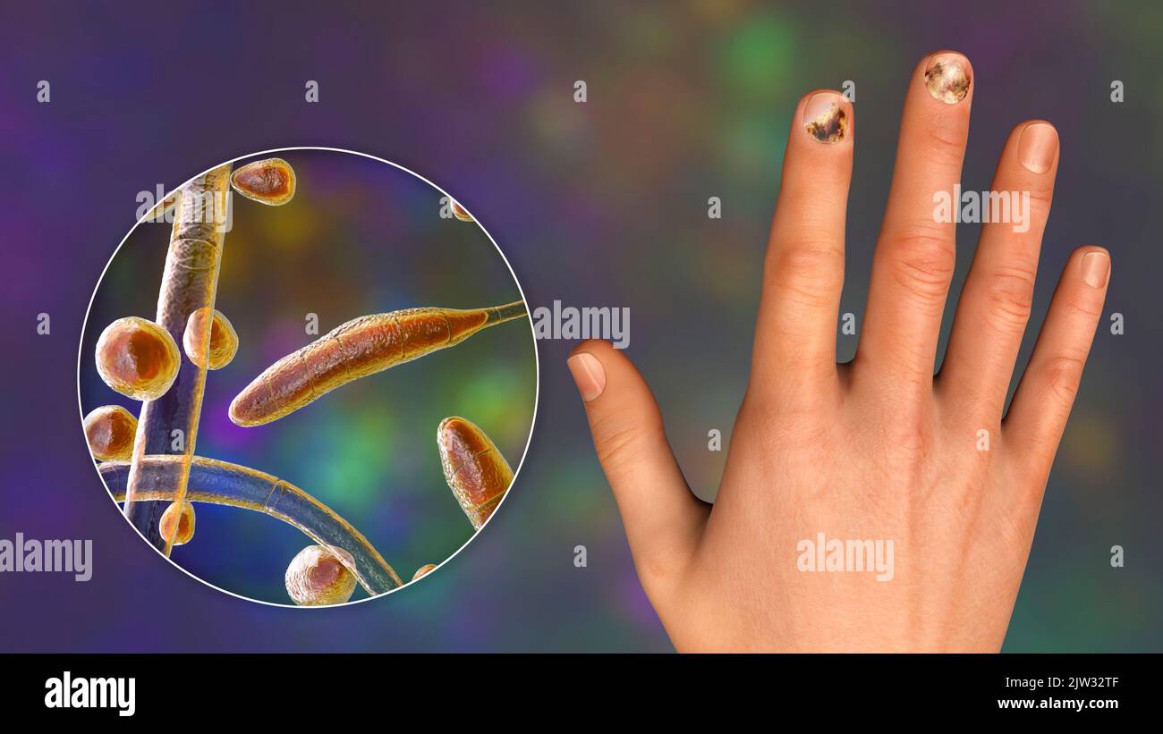 Tinea rubrum -Fotos und -Bildmaterial in hoher Auflösung – Alamy