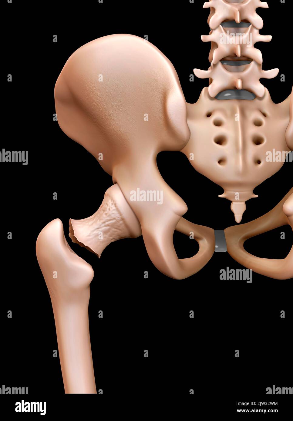 Abbildung zeigt eine Rückansicht einer Fraktur im Oberschenkelhals (Oberschenkelknochen ...