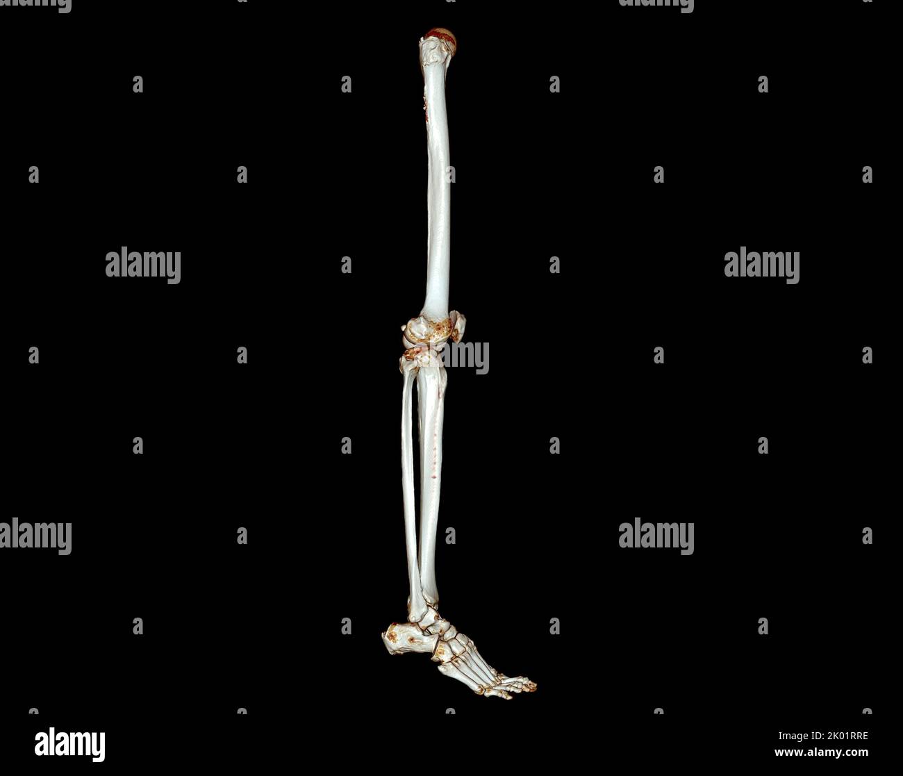CT-Scan der unteren Extremität 3D zur Diagnose Fraktur von Femurknochen ...