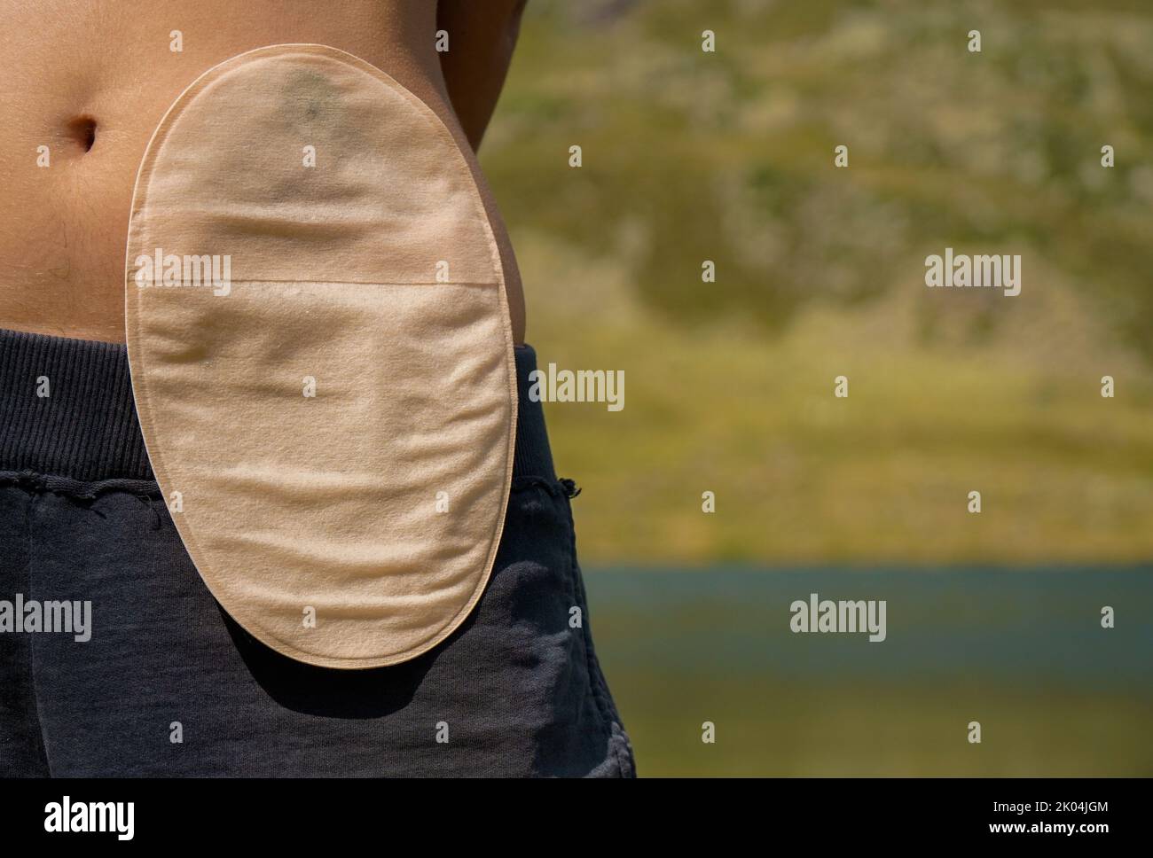 Kolostomie stoma -Fotos und -Bildmaterial in hoher Auflösung – Alamy