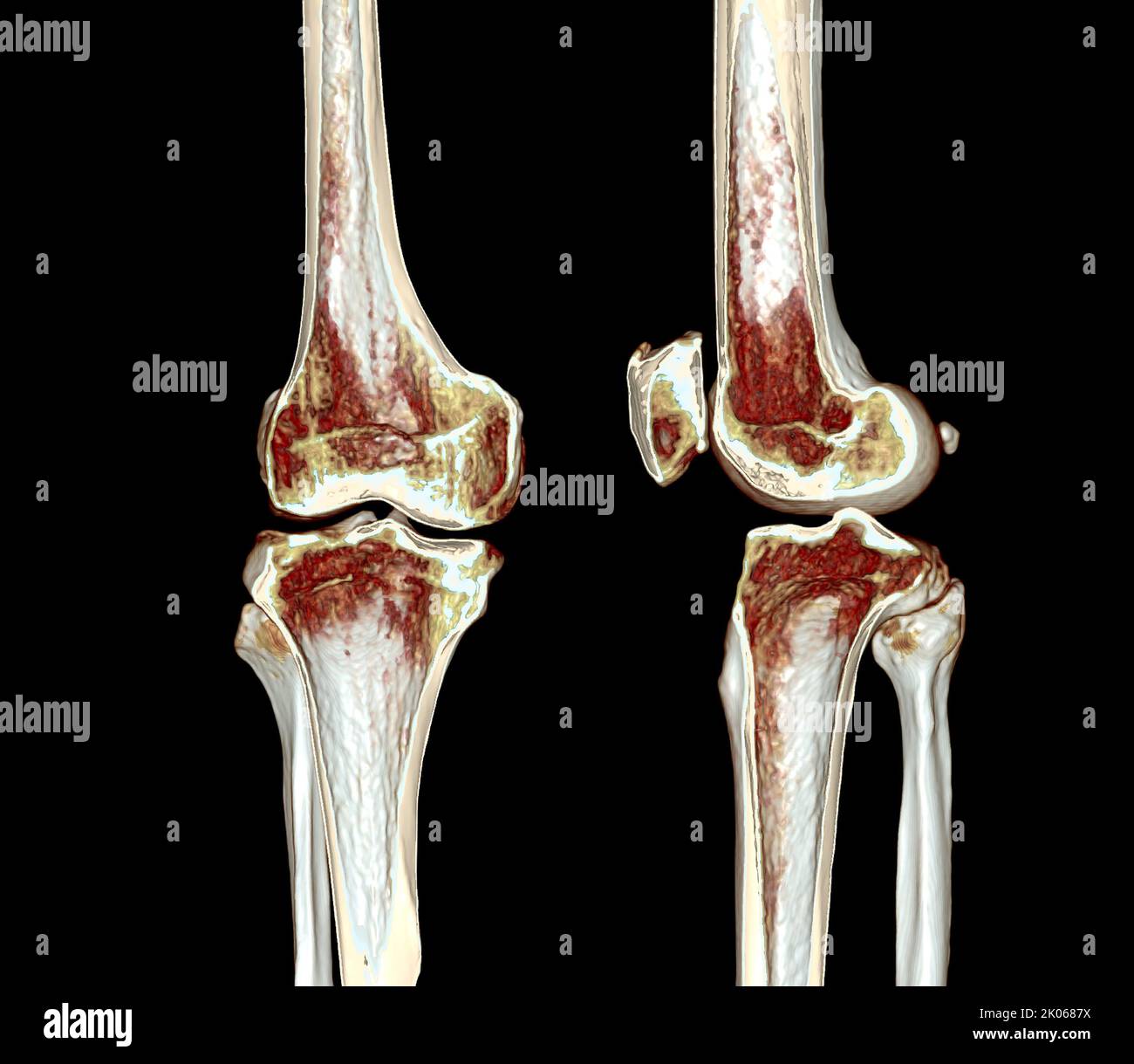 Eine Hälfte des CT-Scans von Knie 3D, das ein auf schwarzem Hintergrund ...