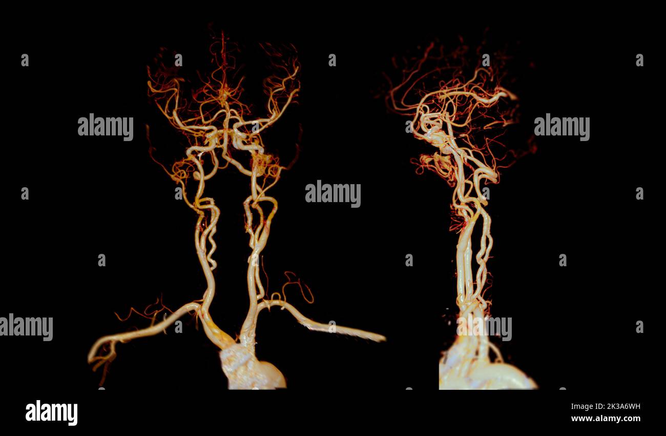 CTA-Gehirn oder CT-Angiographie des Gehirns 3D Rendering-Bild für die ... CTA-Gehirn oder CT-Angiographie des Gehirns 3D Rendering-Bild für die ...