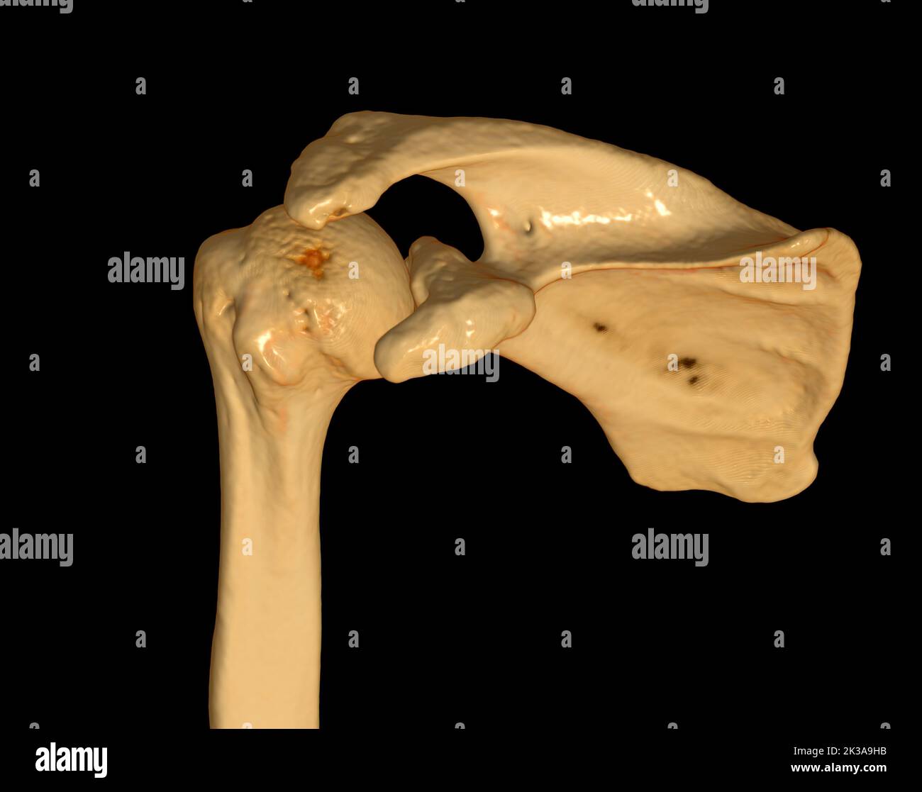 CT Shoulder 3D der Computertomographie Volumen-Rendering-Untersuchung ...