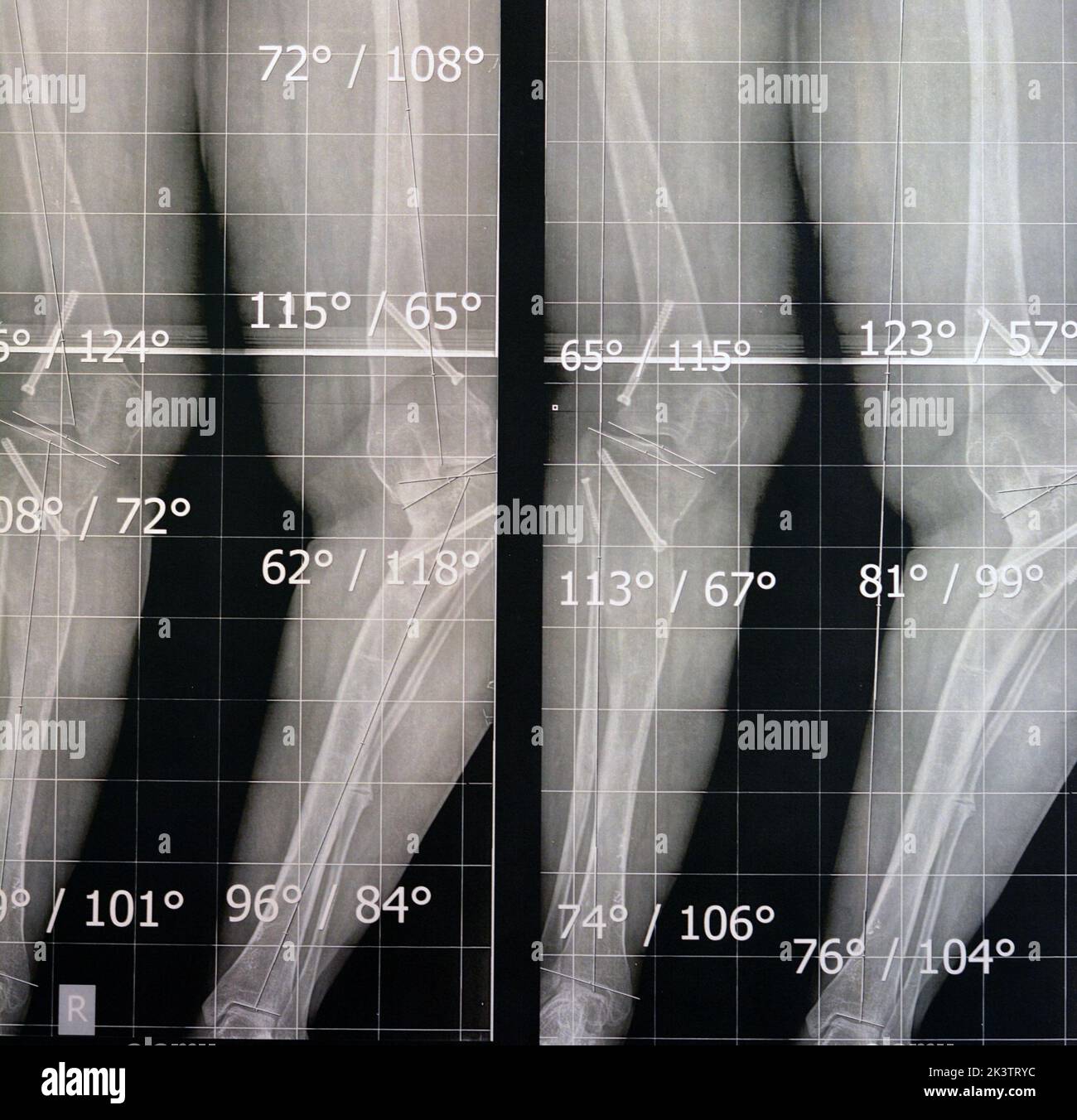 Plain x ray long Film stehende Position zeigt beide Beine mit ...