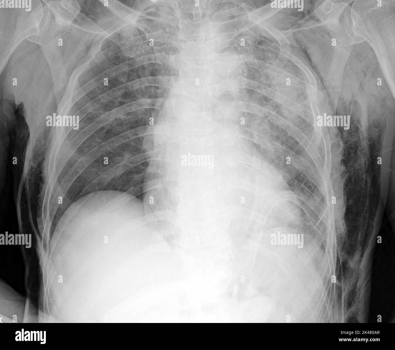 Subkutane luft -Fotos und -Bildmaterial in hoher Auflösung – Alamy