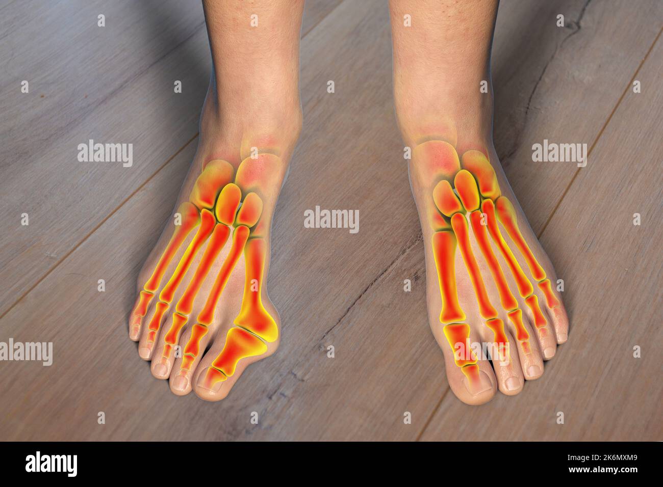 Foot deformities -Fotos und -Bildmaterial in hoher Auflösung – Alamy
