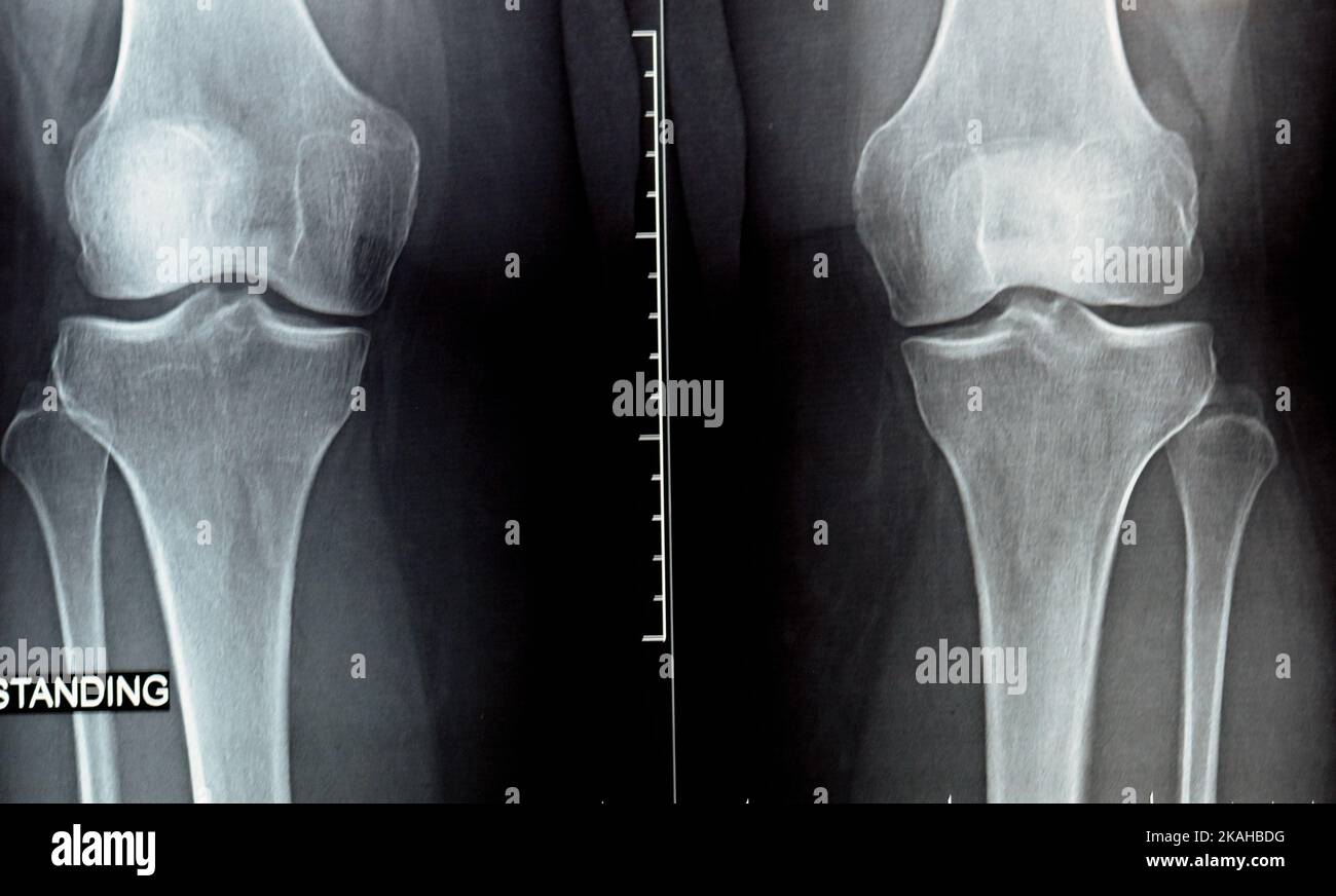 Plain x ray on knee Joint showing joint space narrowing and subchondral ... Plain x ray on knee Joint showing joint space narrowing and subchondral ...