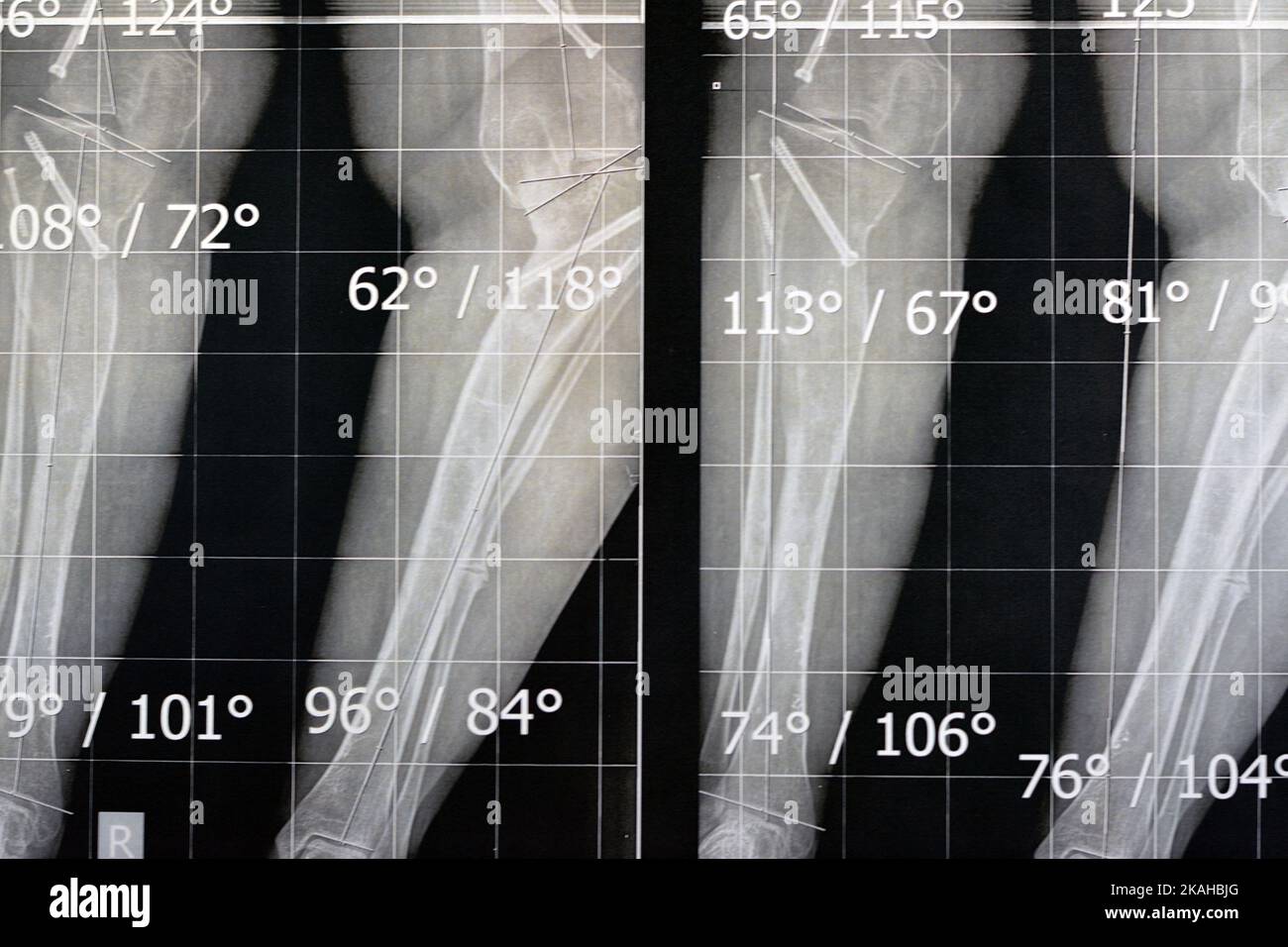 Plain x ray long Film stehende Position zeigt beide Beine mit ...
