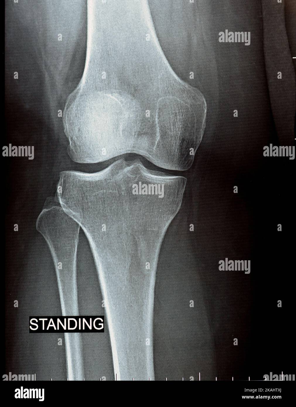 Plain x ray on knee Joint showing joint space narrowing and subchondral ...