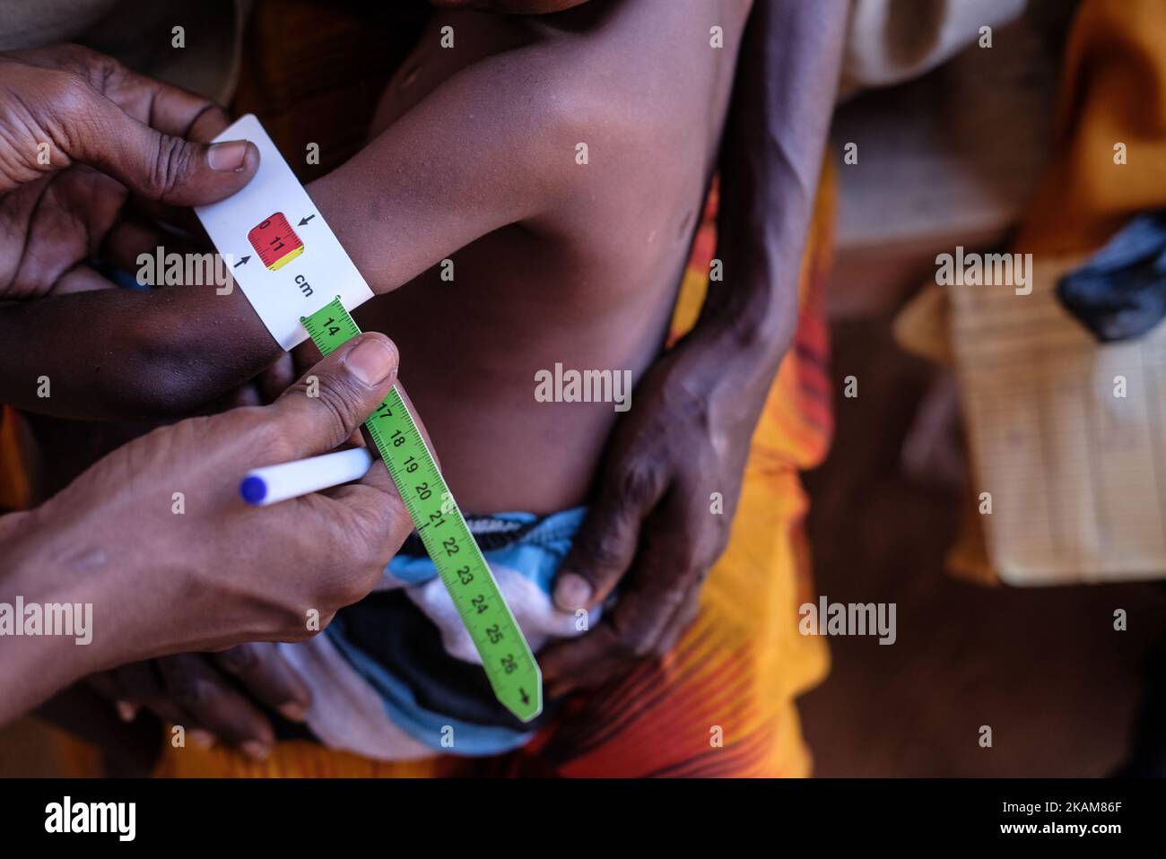 MOGADISCHU, SOMALIA - 25. MÄRZ 2017 - Futterceneter. Der Arzt misst den ...