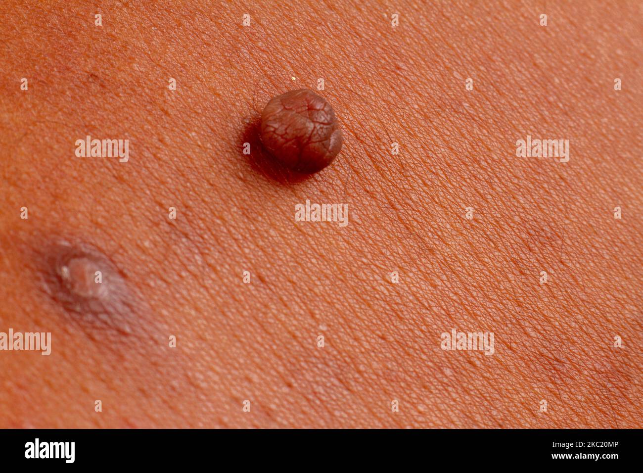 Menschliche Hautstruktur. Warze und Pickel auf der Haut Mikro Foto ...