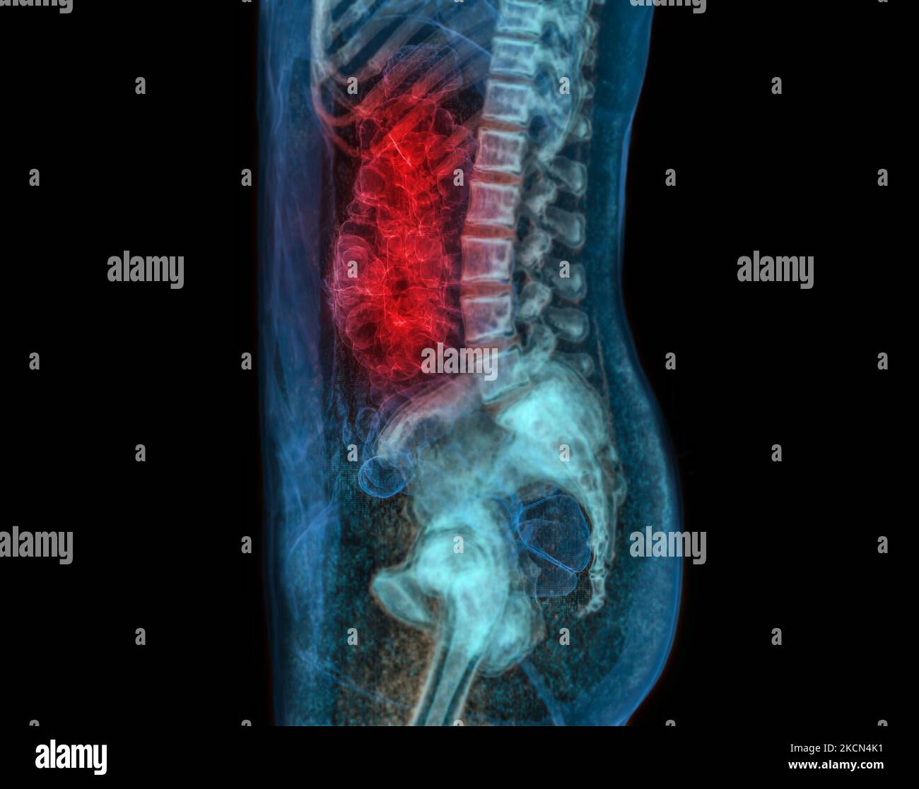 CT-Kolonographie oder CT-Scan von Colon 3D Rendering-Bild für das ...
