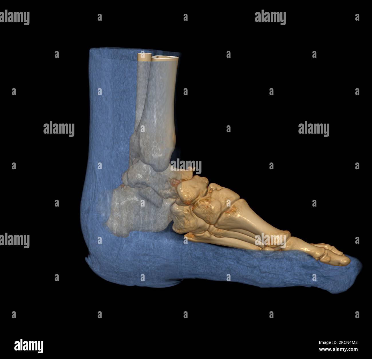 3D Darstellung der Fußknochen zur Diagnose Knochenbruch und rheumatoide ...