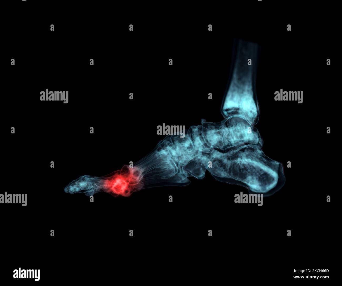 3D Darstellung der Fußknochen zur Diagnose Knochenbruch und rheumatoide ...