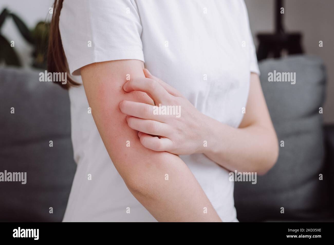 Nahaufnahme von verärgerten, ungesunden Juckreiz junger Frauen am Arm ...