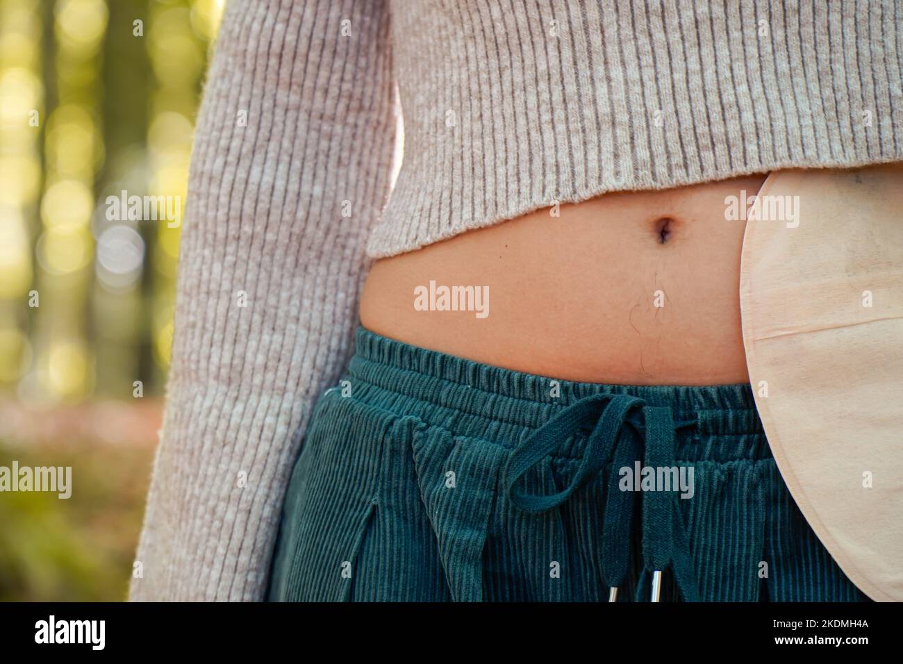Abdomen einer Frau, die den Nabel freilegt, und ein ostomiger Beutel im ...