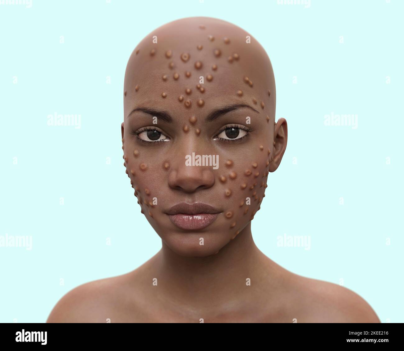 Infektion der hautstruktur -Fotos und -Bildmaterial in hoher Auflösung ...