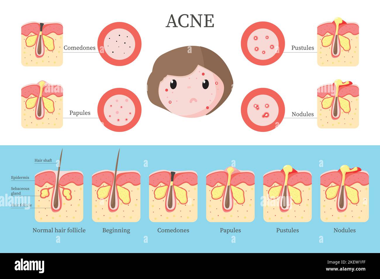 Pimple illustration Stock-Vektorgrafiken kaufen - Alamy