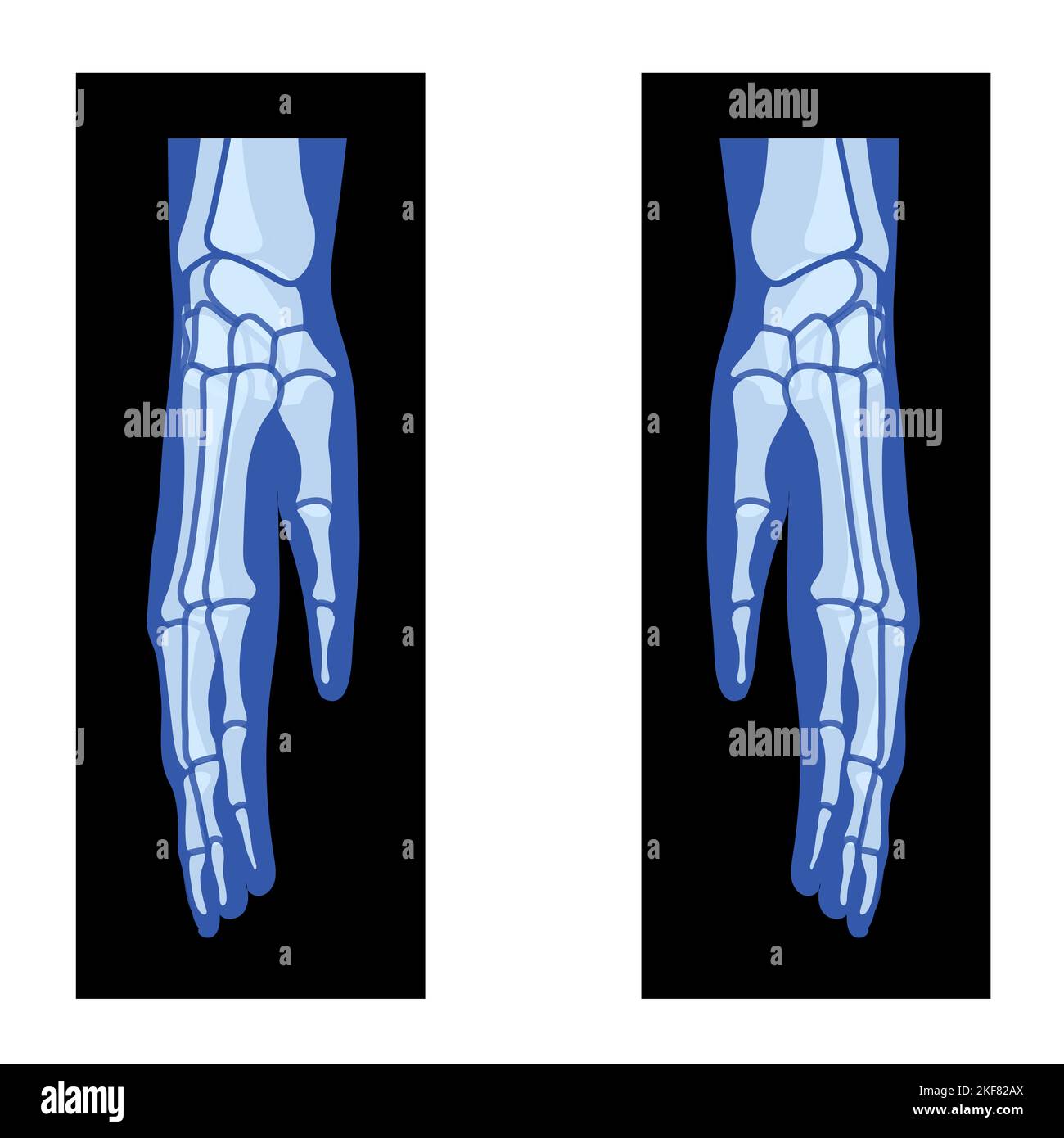 Röntgen-Hände mit Radius, Ulna Skelett menschlichen Körper, Knochen ...