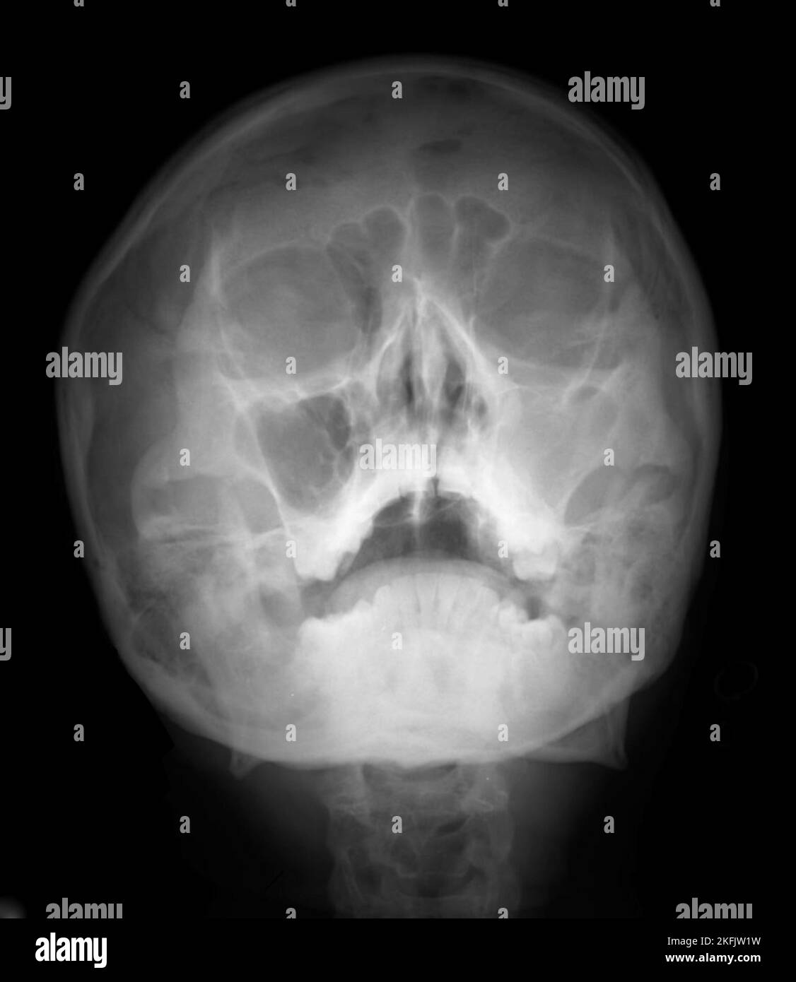 Sinus blockiert -Fotos und -Bildmaterial in hoher Auflösung – Alamy