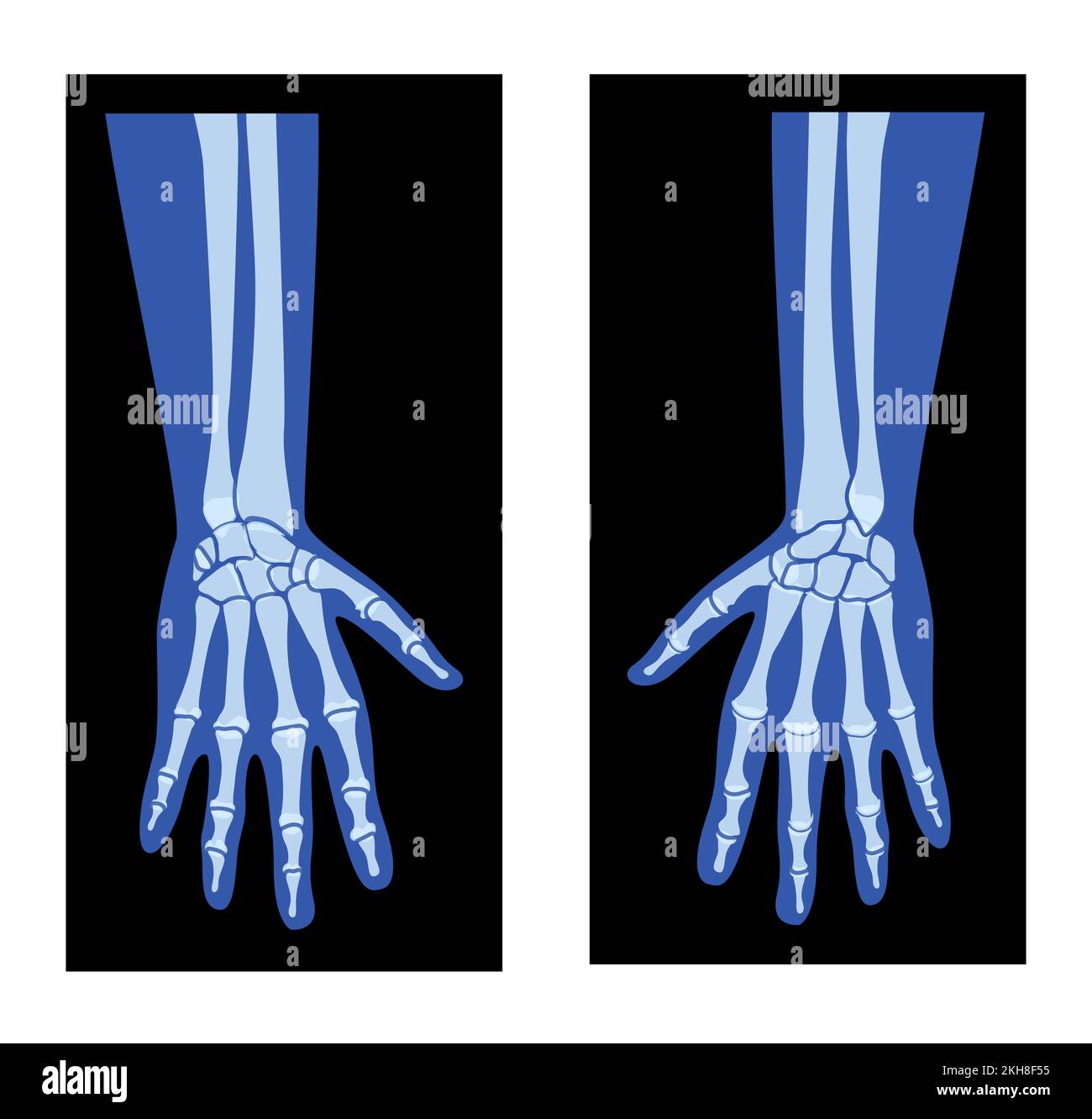 Röntgen Hände mit Radius, Ulna Skeleton menschlicher Körper, Knochen ...
