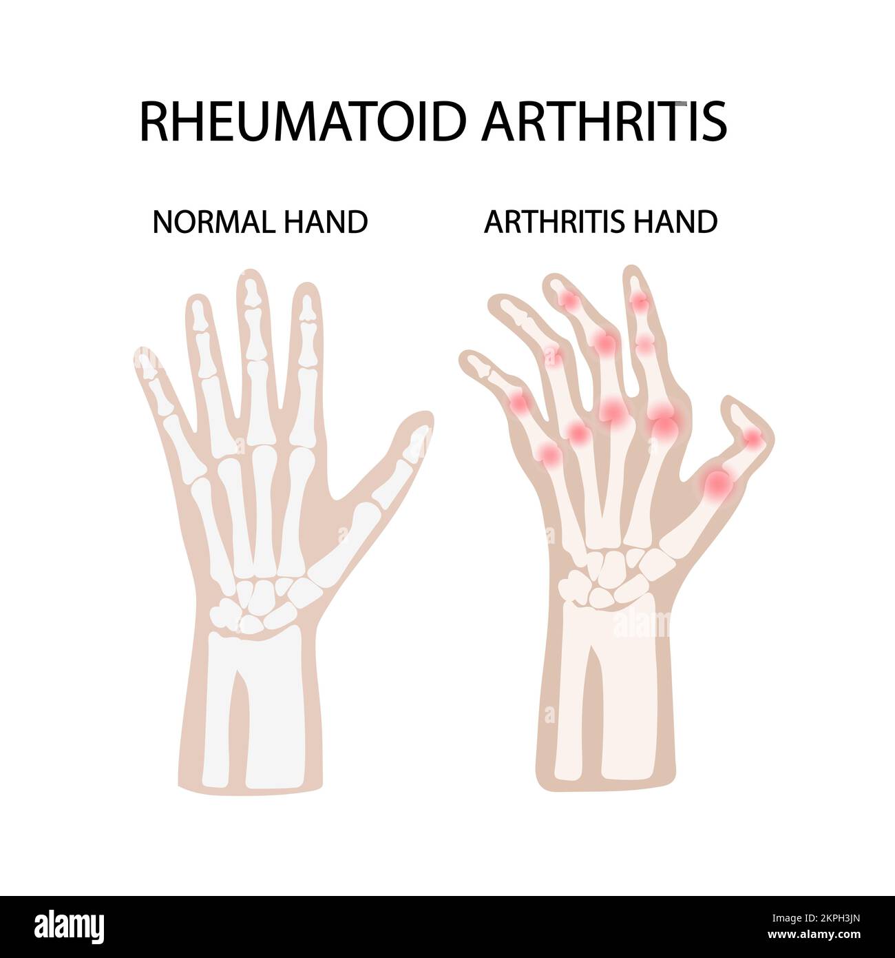 RHEUMATOIDE ARTHRITIS LÄSIONEN der Gelenke der Hände des Menschen mit ... RHEUMATOIDE ARTHRITIS LÄSIONEN der Gelenke der Hände des Menschen mit ...