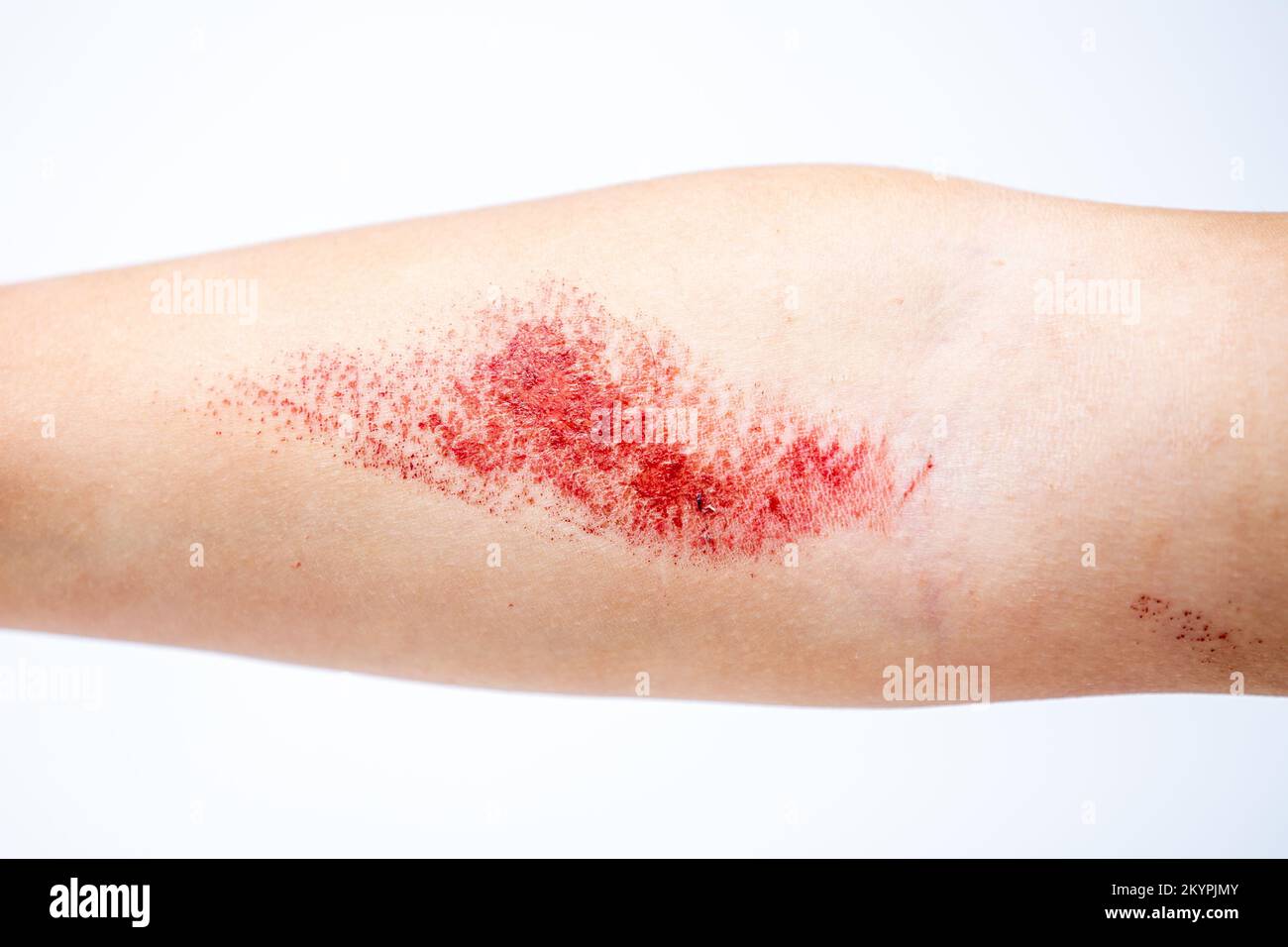 Verbrannter arm -Fotos und -Bildmaterial in hoher Auflösung – Alamy
