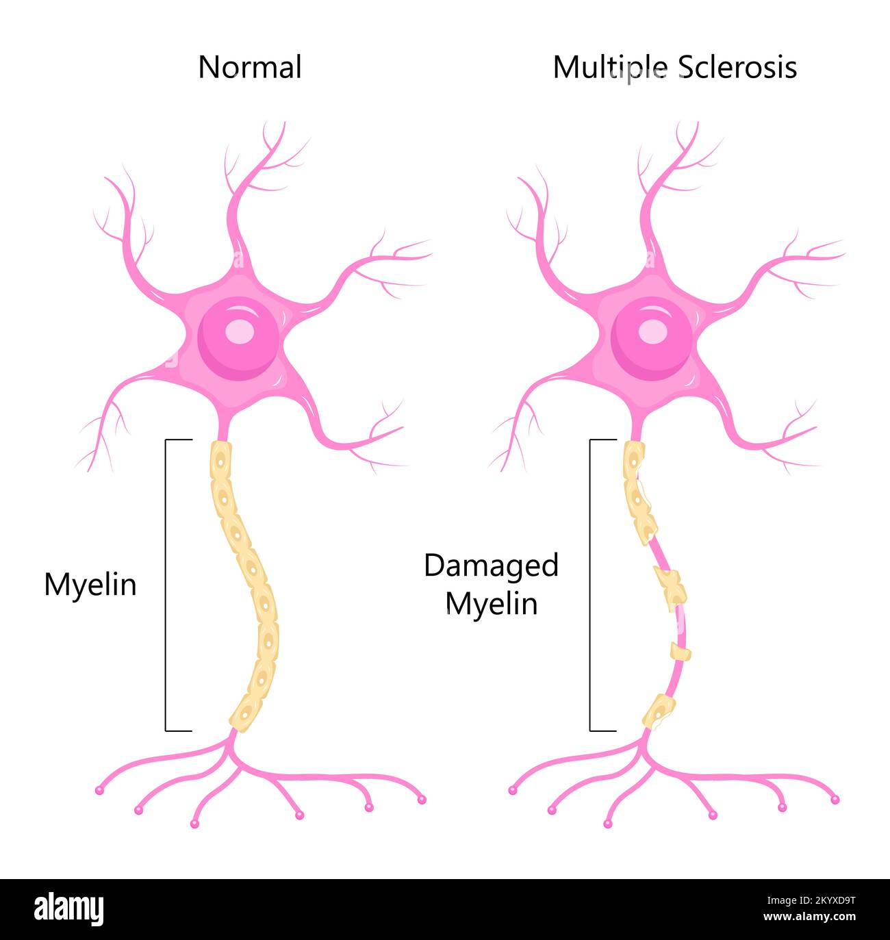 Neuron-Concept-Vektor. Dendrite, Axon, neuronsoma. Multiple Sklerose ...