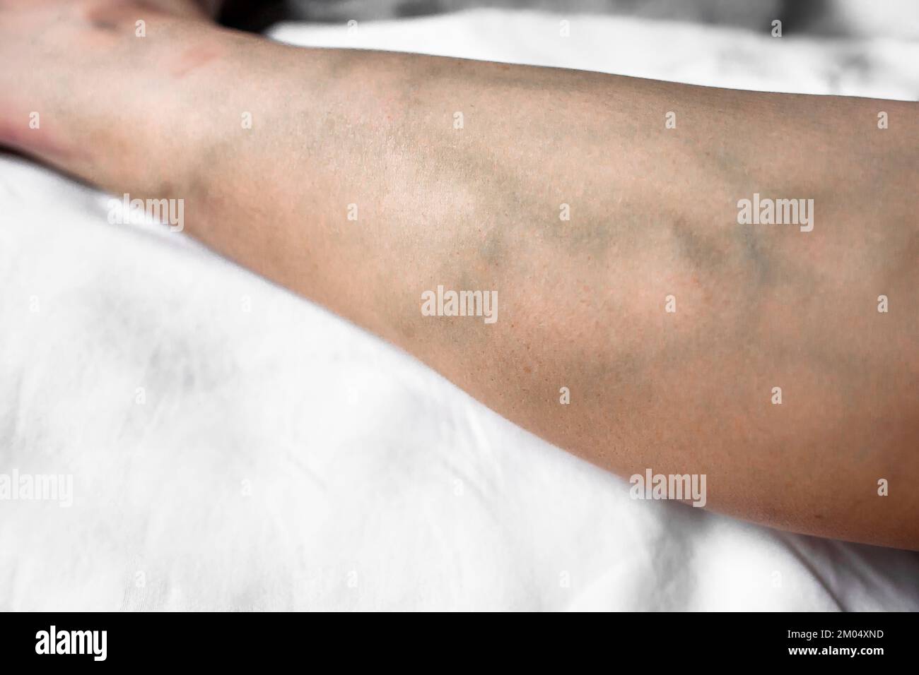 Ein Bein mit Krampfadern schließt Krampfadern im Bein im Sitzen, Venen ...