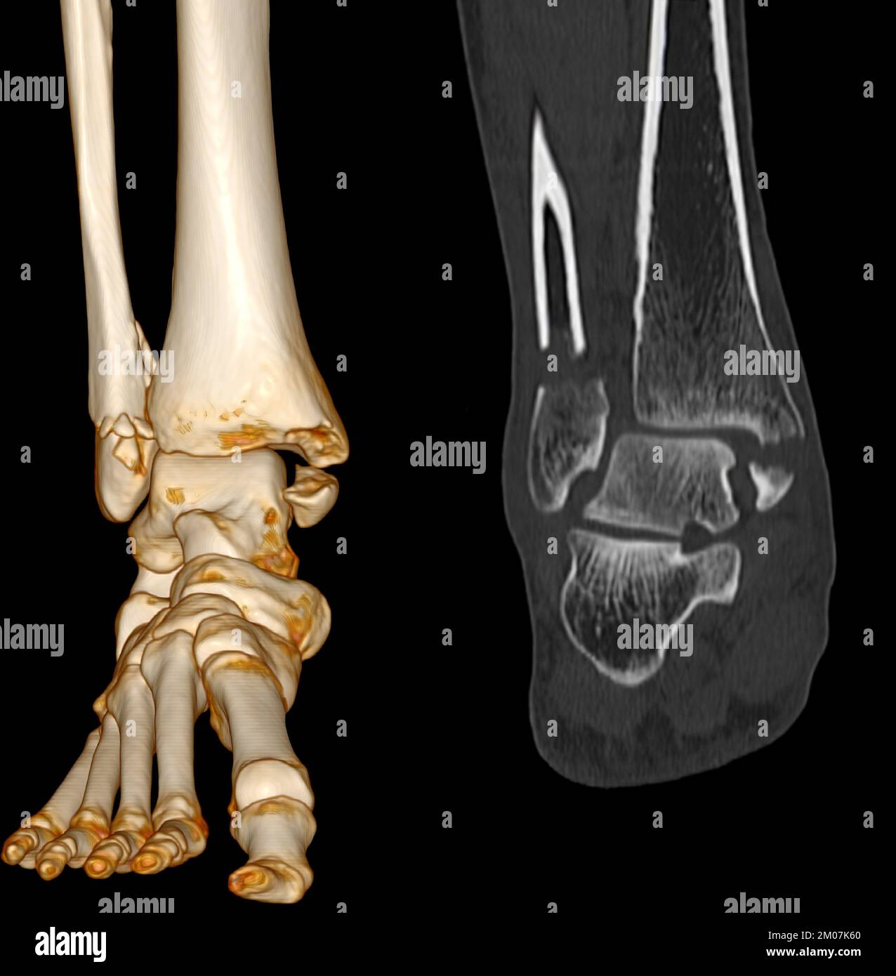 CT-Scan Knöchel und Fuß oder Computertomographie des Sprunggelenks und ...