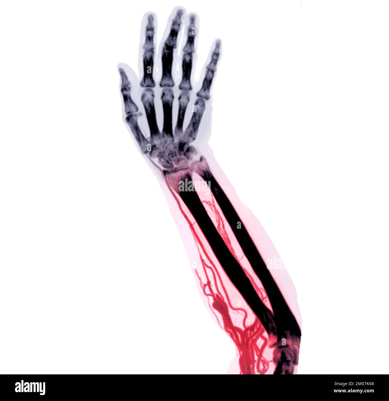 Arteria brachialis cta -Fotos und -Bildmaterial in hoher Auflösung – Alamy