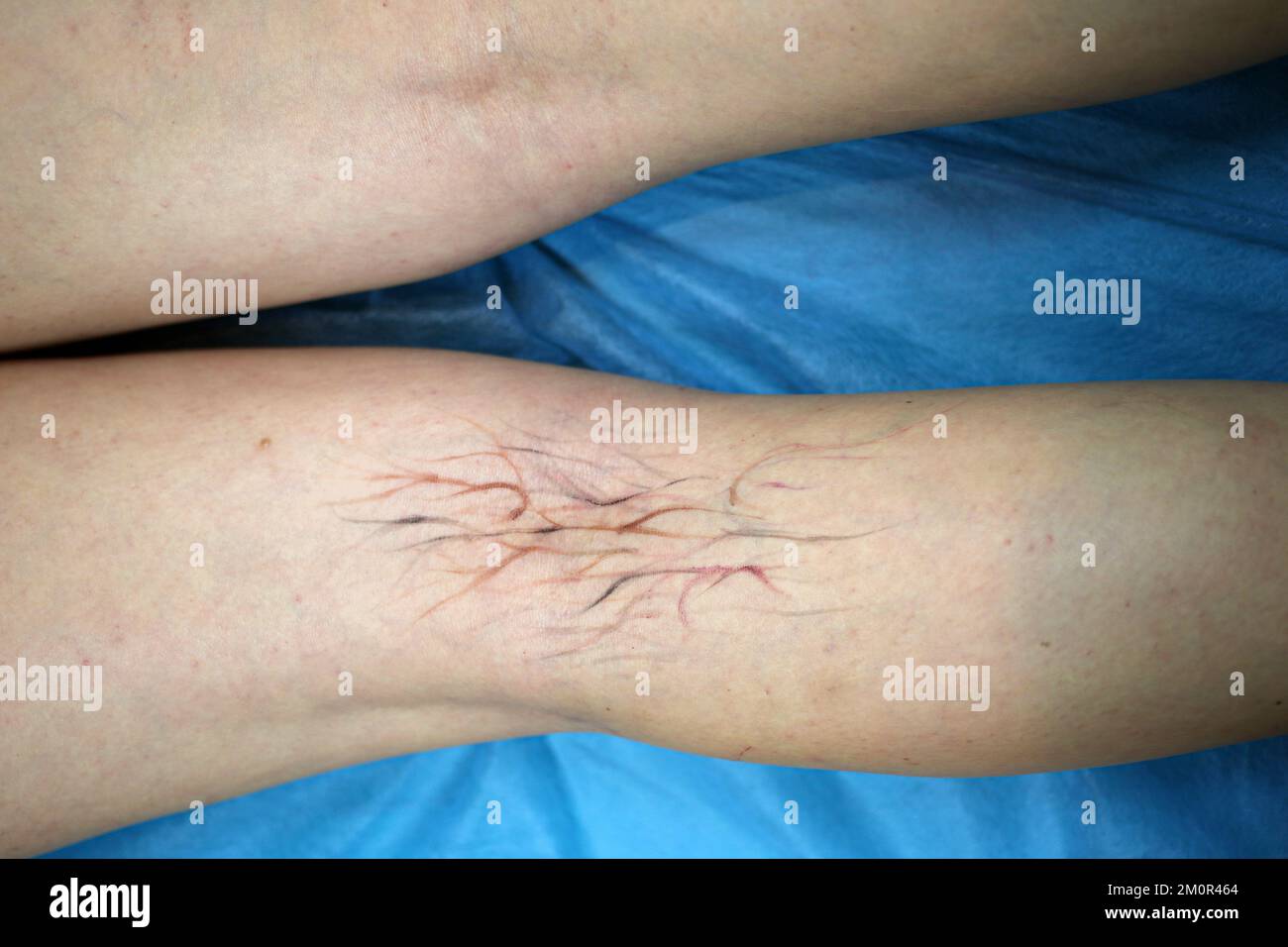 Lower limb -Fotos und -Bildmaterial in hoher Auflösung – Alamy