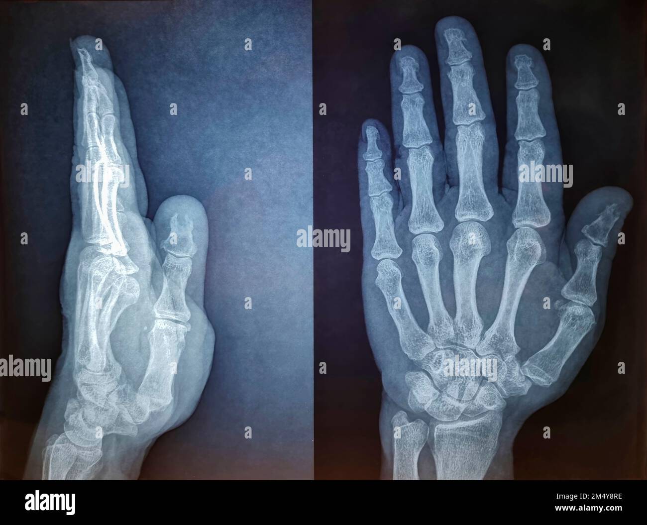 Daumen röntgen -Fotos und -Bildmaterial in hoher Auflösung – Alamy