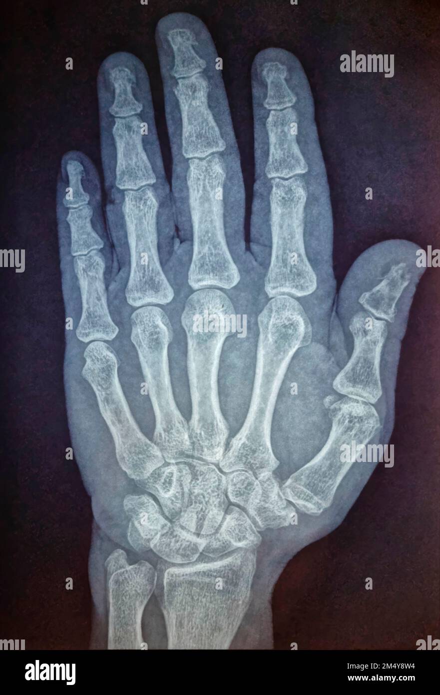 Rontgenbild Einer Hand 1