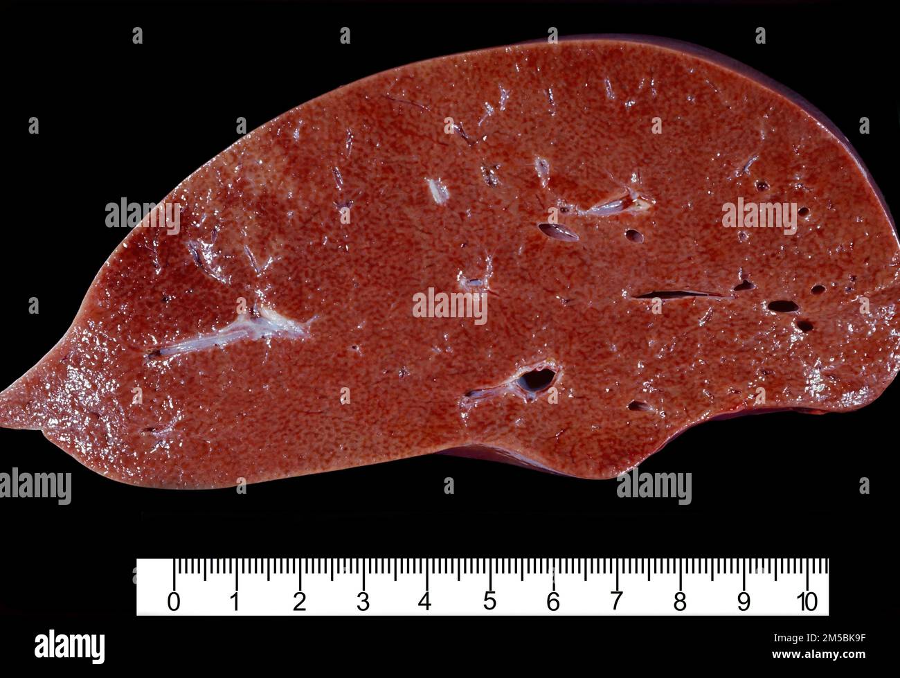 Kongestive Hepatopathie (Muskatnuss-Leber) ist eine ...