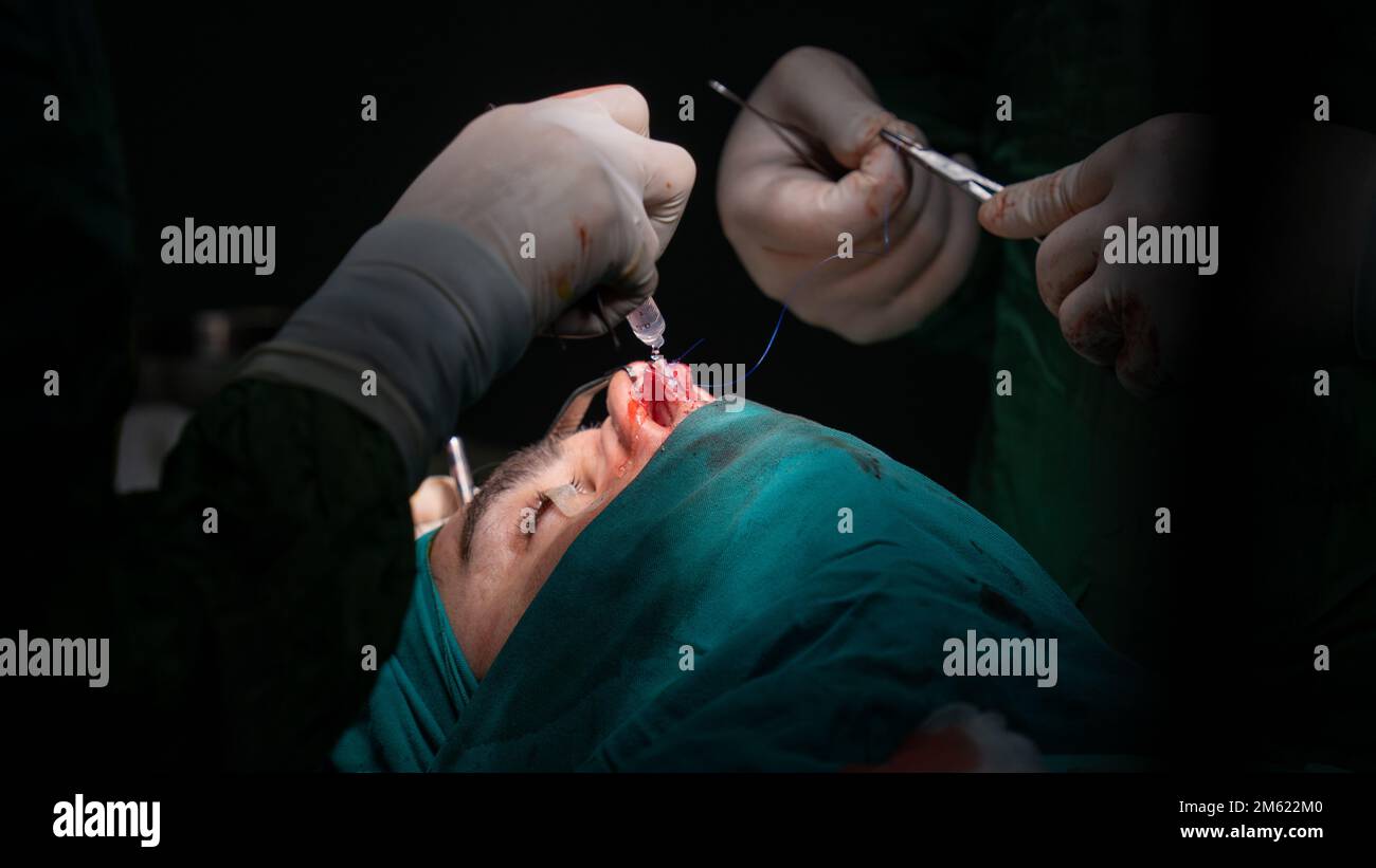 Rhinoplastik-Chirurgie, Defekte der Nasenform bei der Patientin ...