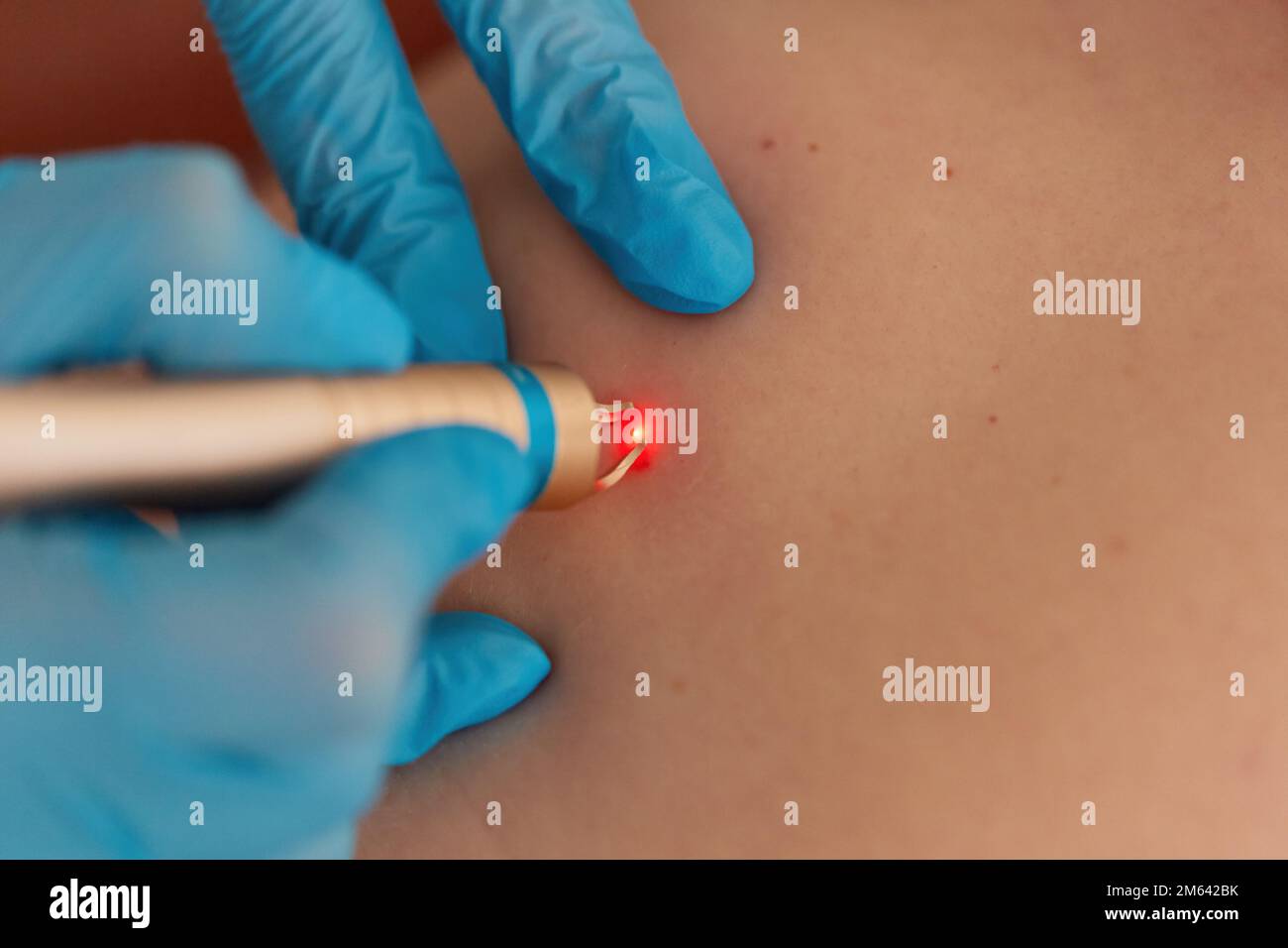 Narbe laser -Fotos und -Bildmaterial in hoher Auflösung – Alamy