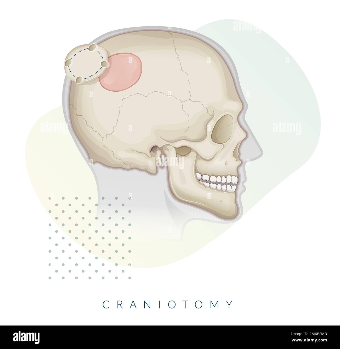 Kraniotomie chirurgie -Fotos und -Bildmaterial in hoher Auflösung – Alamy