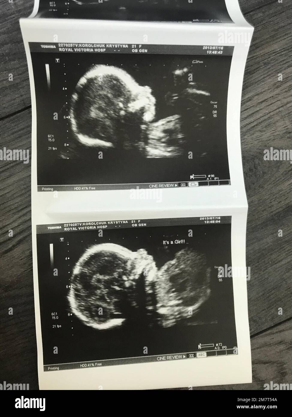 Baby xray -Fotos und -Bildmaterial in hoher Auflösung – Alamy