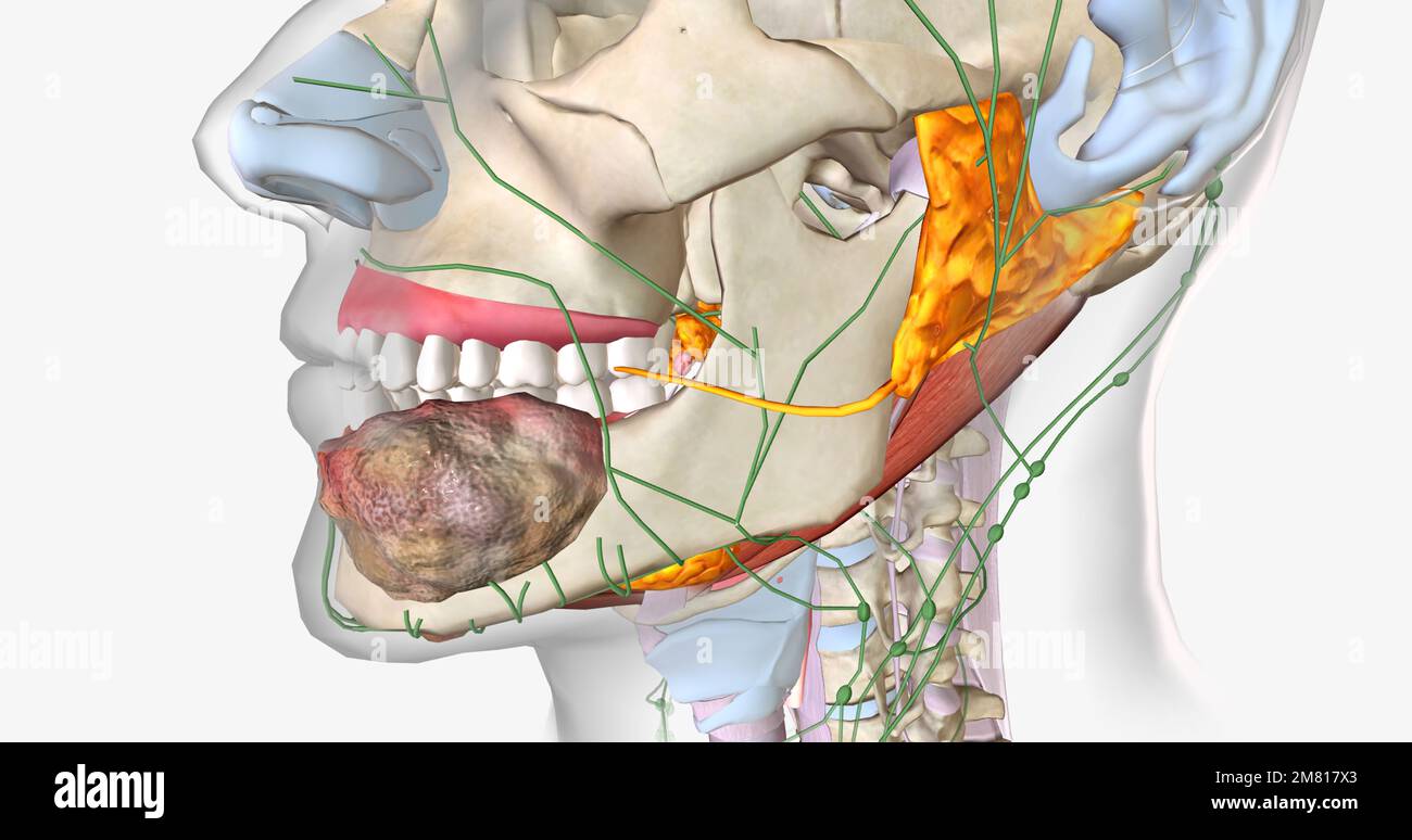 Sobald sich ein Tumor in nahe gelegene Lymphknoten ausgebreitet hat ...