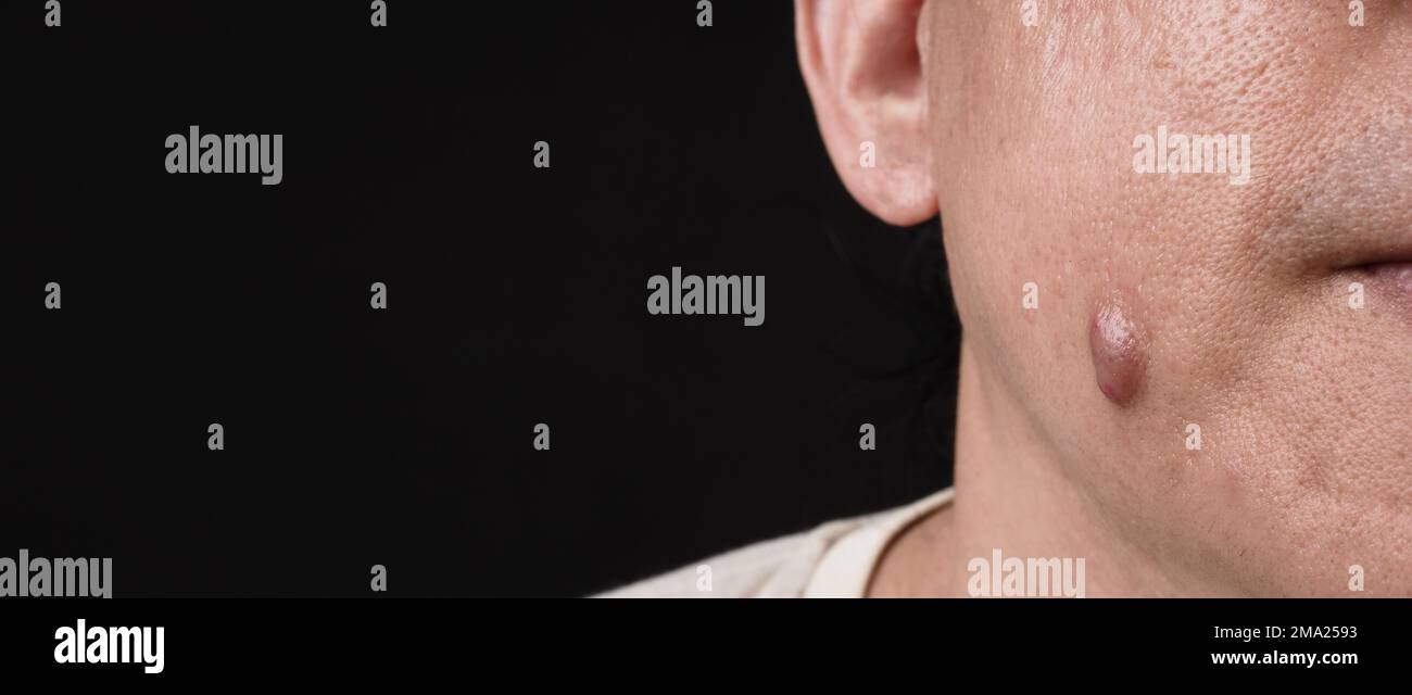 Zyste akne -Fotos und -Bildmaterial in hoher Auflösung – Alamy