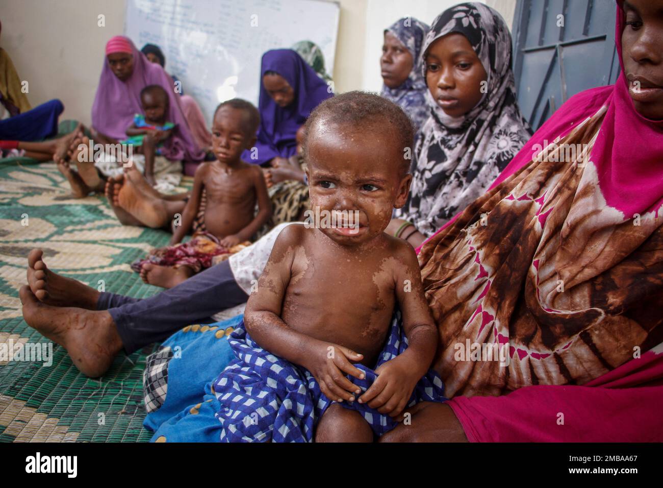 Somali children displaced by drought and showing symptoms of ...