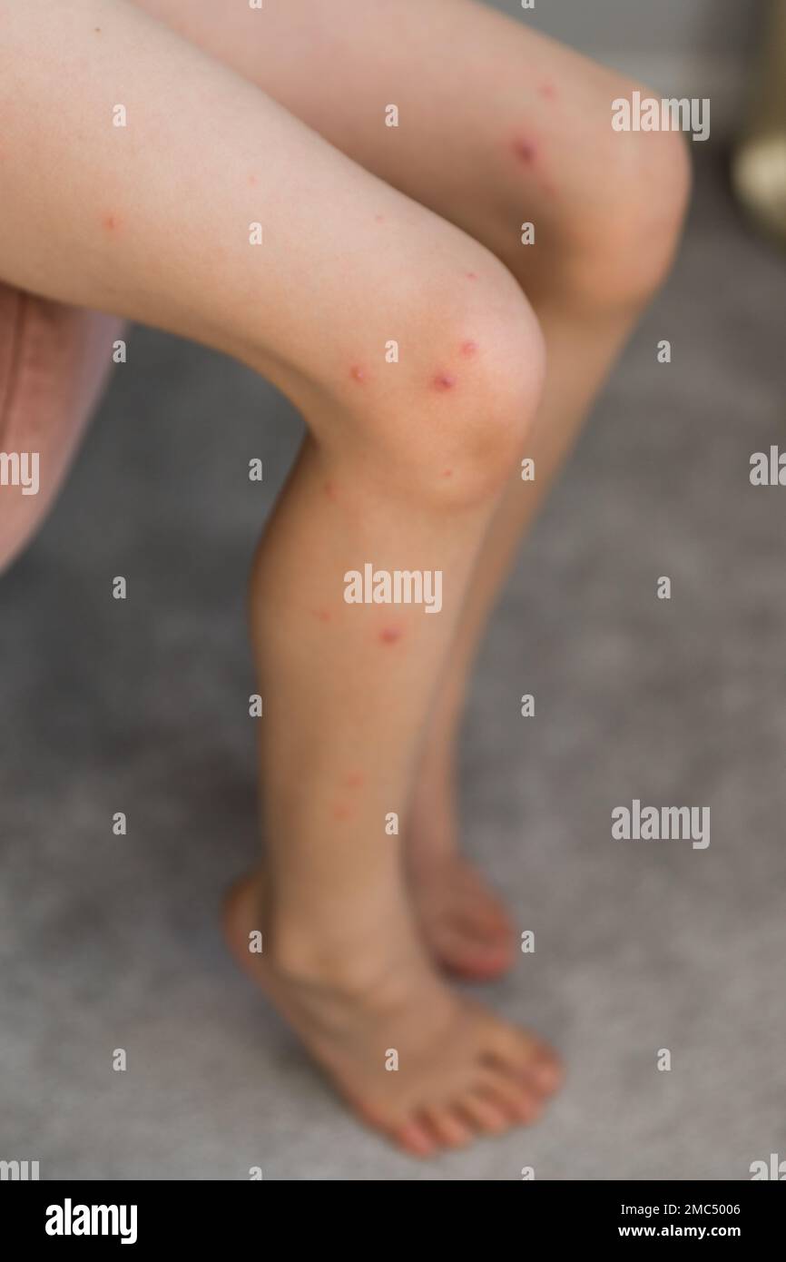 Jungkind mit Windpocken. Krankes Kind mit Windpocken. Varizellen-Virus ...