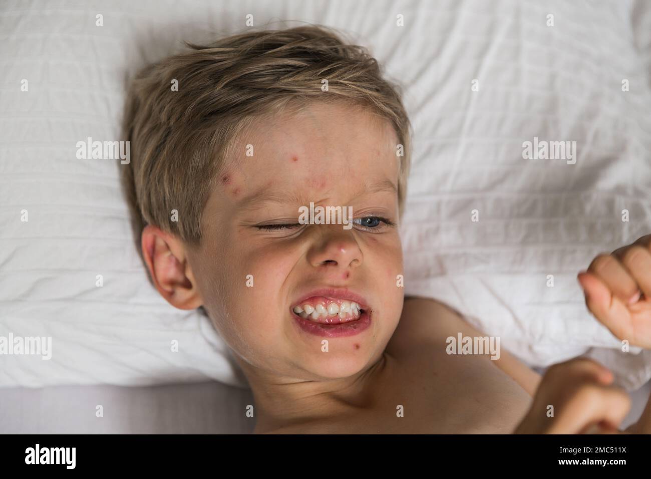 Jungkind mit Windpocken. Krankes Kind mit Windpocken. Varizellen-Virus ...