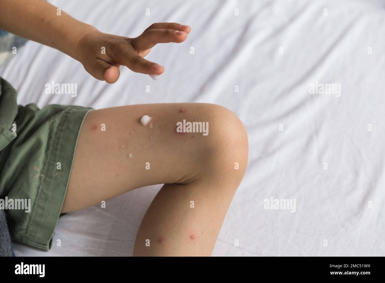 Jungkind mit Windpocken. Krankes Kind mit Windpocken. Varizellen-Virus ...